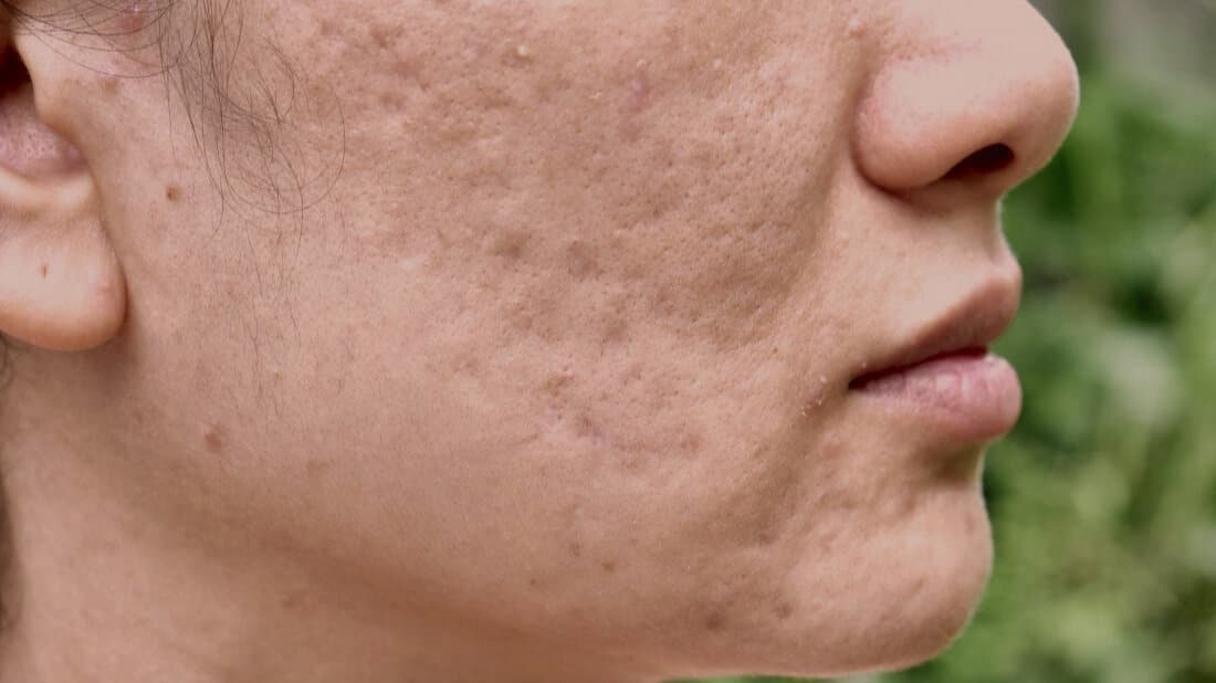 Fractional CO2 Laser Treatment Bexleyheath UK| SR Derma Clinic